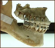 Odontologist and Forensics: Forensic Odontology