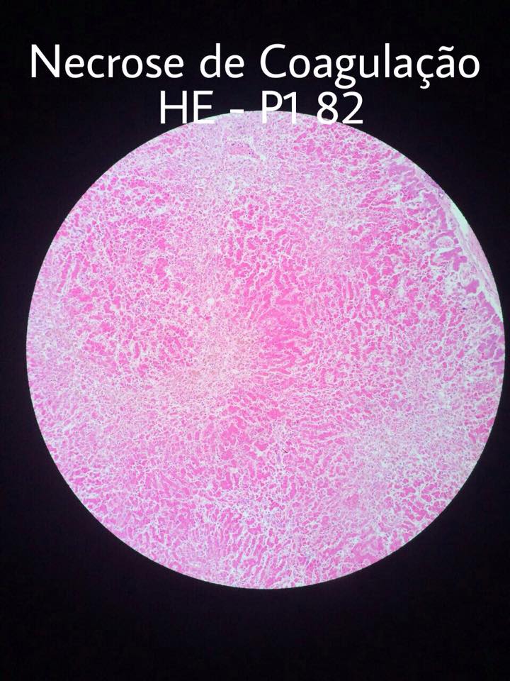 HISTOLOGIA90: TIPOS DE NECROSE