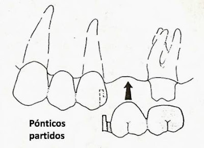 PROTESIS DENTAL : PONTICO