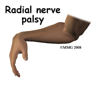 USMLE Review Notes: Radial Nerve Palsy