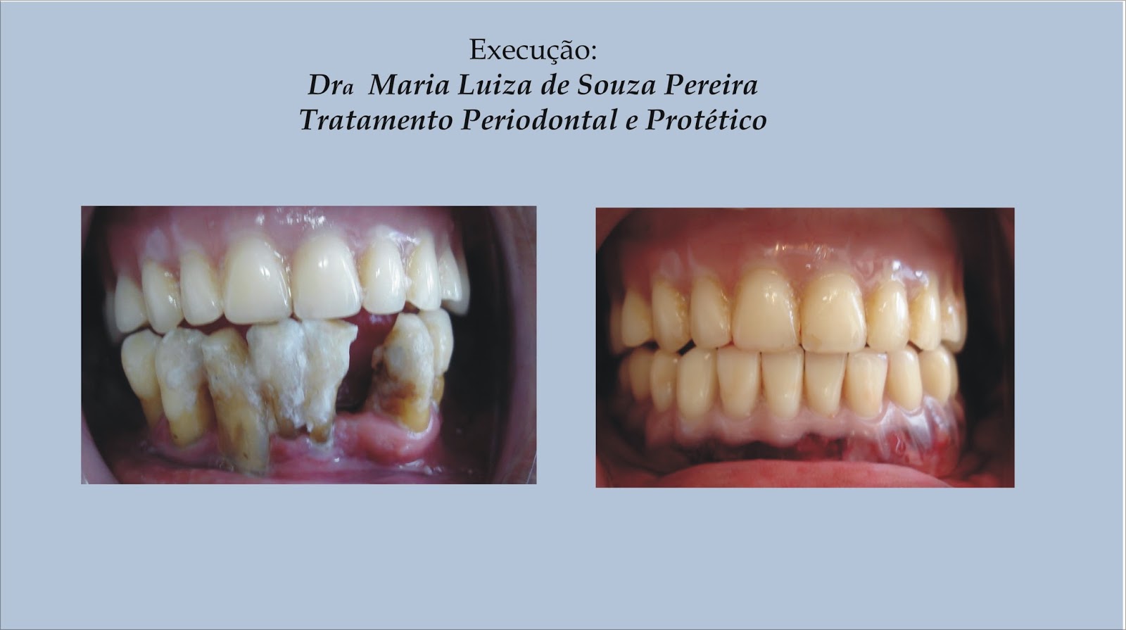 SORRISO! : PERIODONTITE