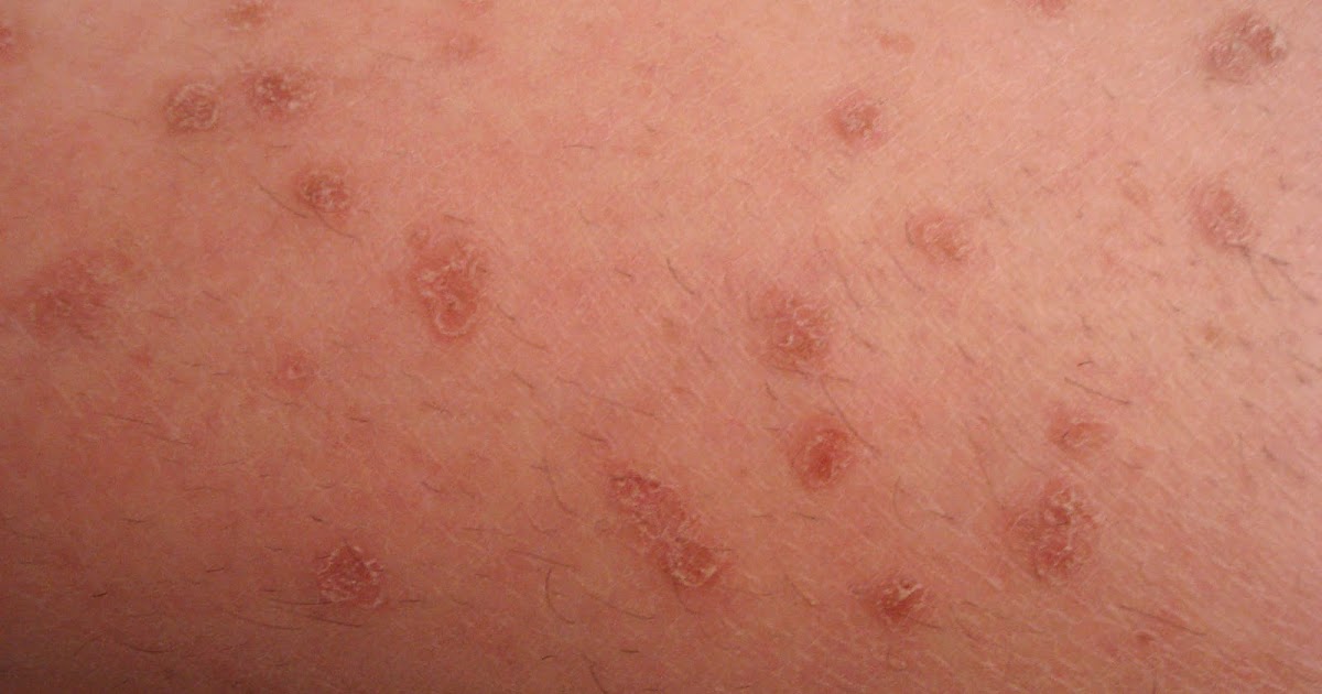 VIRTUAL GRAND ROUNDS IN DERMATOLOGY 2.0: Primary Biliary Cholangitis ...