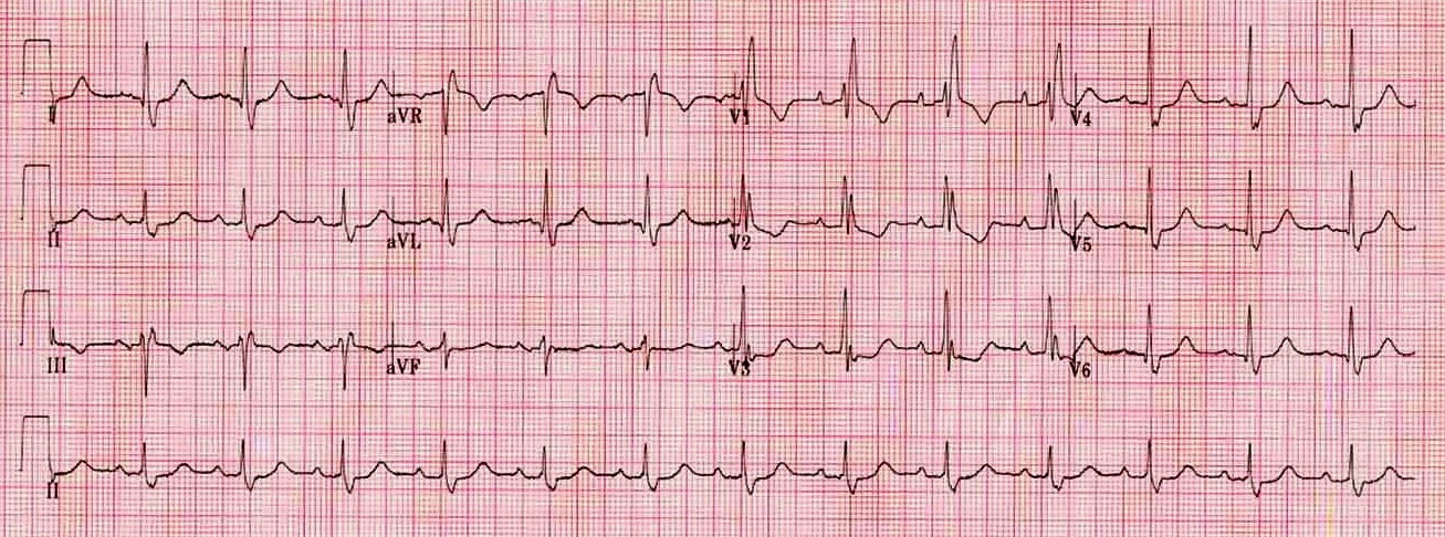 Right Bundle Branch Block | INA - ECG