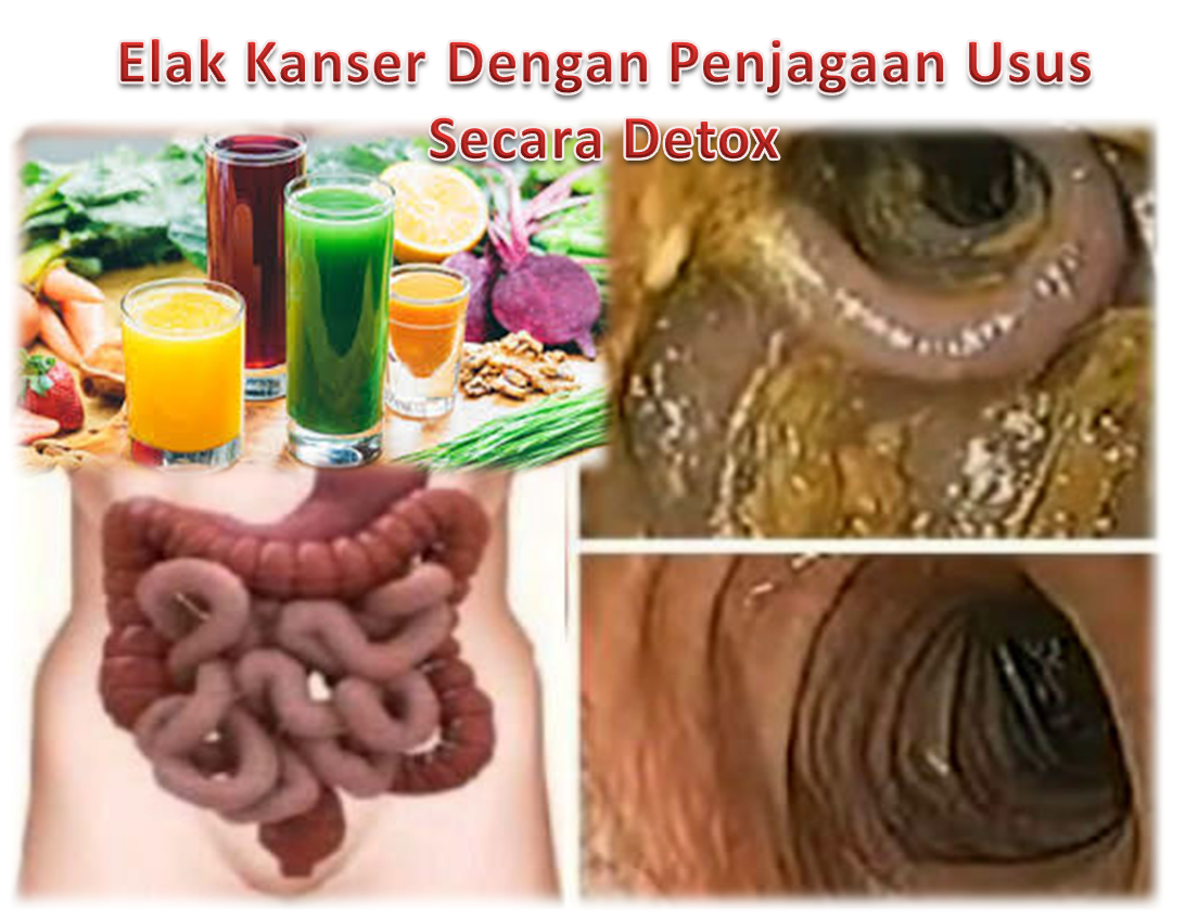 Elak Kanser Dengan Penjagaan Usus Secara Detox ~ Cara Hidup Sihat