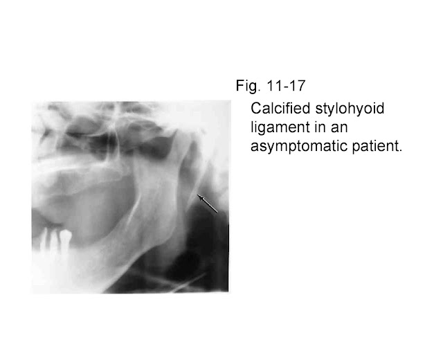 SOFT TISSUE CALCIFICATIONS IN ORO-MAXILLO FACIAL REGION-with ...