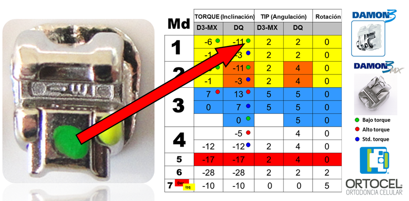 ORTOCEL: Tabla de prescripción de los brackets DAMON.