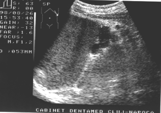 imagini splina Circulatie colaterala ecografie | Terapii naturiste si ...