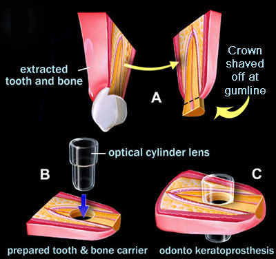 dentisTRY: EYETOOTH IMPLANT: Tooth implantation in eye for blind person