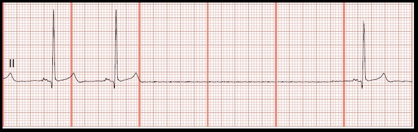 Float Nurse: EKG Rhythm Strip Quiz 193