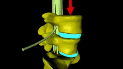 All about herniated disc symptoms , surgery , treatment , exercises and ...