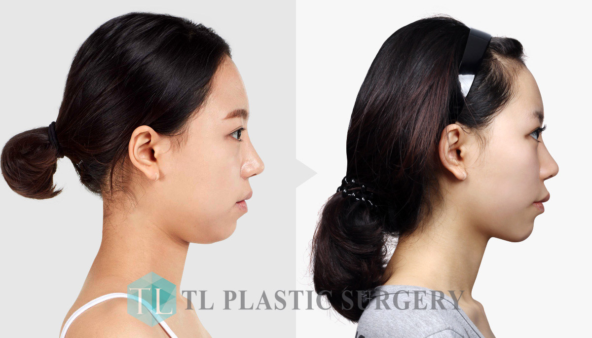 Face and Buccal Fat Cheek Lipo for Double Chin and Jowls - TL ANTI ...