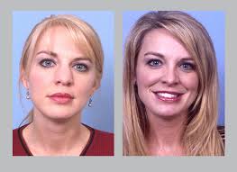 Cosmetic Surgery Services In Hyderabad: Wide Nose Correction