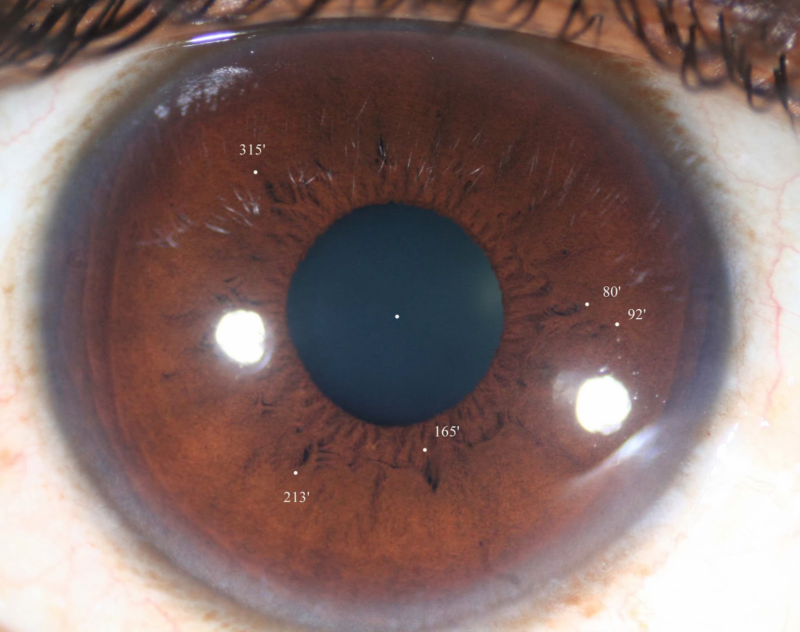 Modern & Multidimensional Iridology: Crypts at Pupillary Zone ...