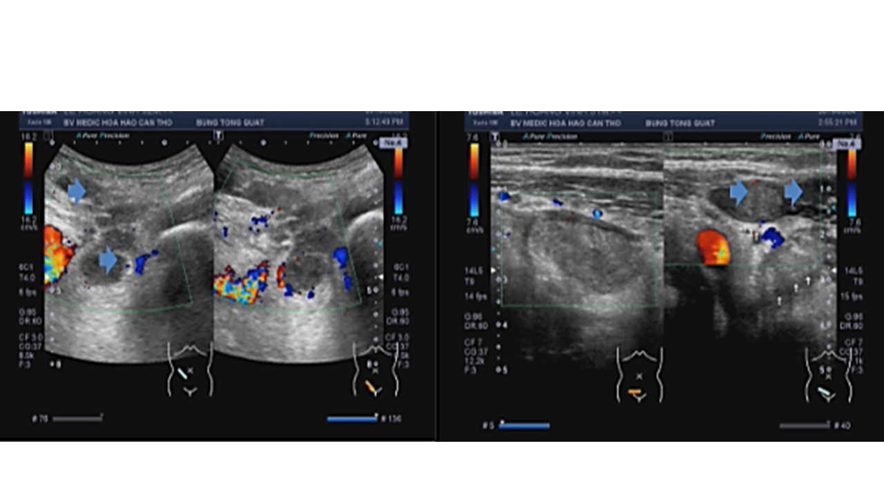 VIETNAMESE MEDIC ULTRASOUND: CASE 543: PELVIC WALL ABSCESS, Dr PHAN ...