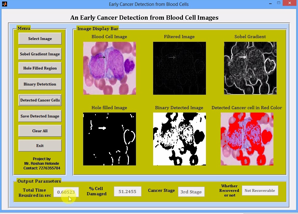 Automated Leukemia Cancer Detection Using Image Processing Matlab