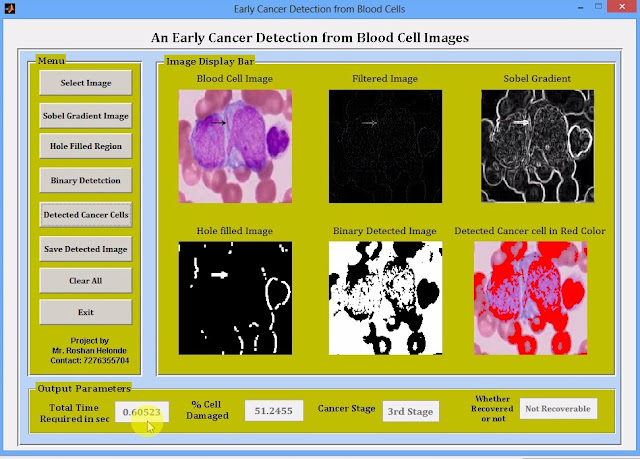 Automated Leukemia Cancer Detection Using Image Processing Matlab Project with Source Code ...