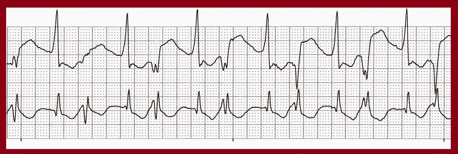 Practice EKG Strips 317
