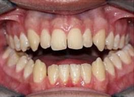 tipos de mordida: Tipos de mordida