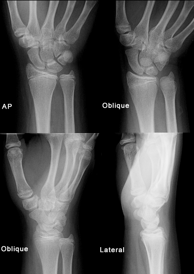 Bone Section: Normal Hand and Wrist Anatomy