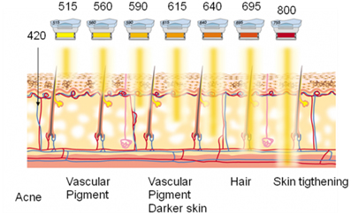 NaBella Clinic By NaBell: เมดดิซิส เลเซอร์ (Medisyst IPL) คืออะไร ...