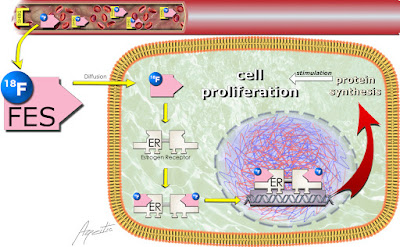PET-CT BEYOND 18FDG: A NEW TELLING OF AN OLD TALE: Figure 6. [18F]-FES