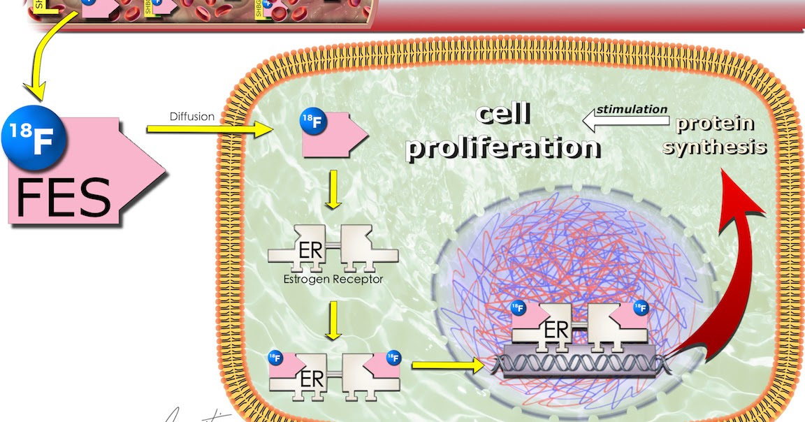 PET-CT BEYOND 18FDG: A NEW TELLING OF AN OLD TALE: Figure 6. [18F]-FES