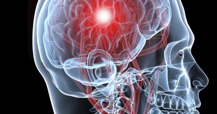 AVC - ACIDENTE VASCULAR CEREBRAL: AVC, a doença que mais mata no Brasil