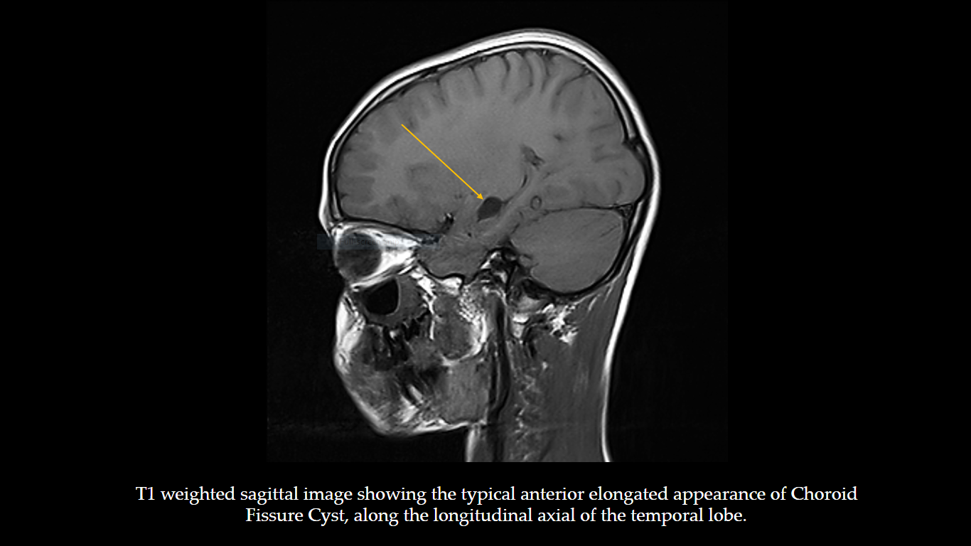 Ultimate Radiology : Choroid Fissure Cyst