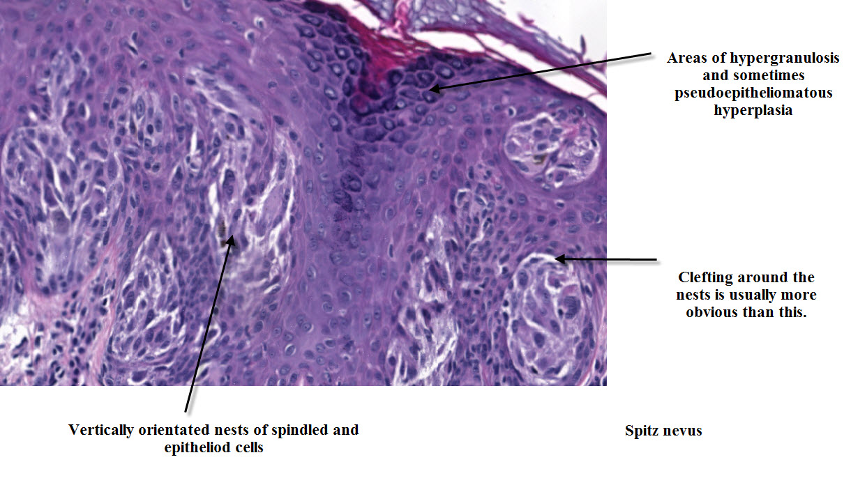 Dermpath Made Simple - Neoplastic: Spitz Nevus and Reed Nevus