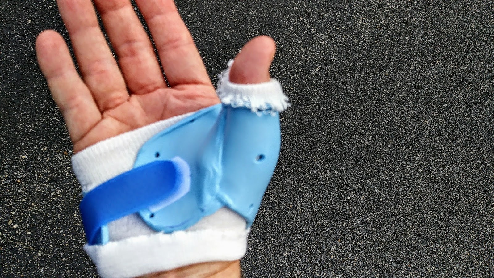 The On-Line Buzzletter: Update: Rob's Dislocated Thumb Surgery