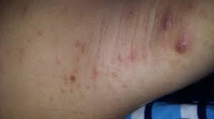 Ketiak gatal timbul bintik merah dan terasa perih panas | kios obat ...