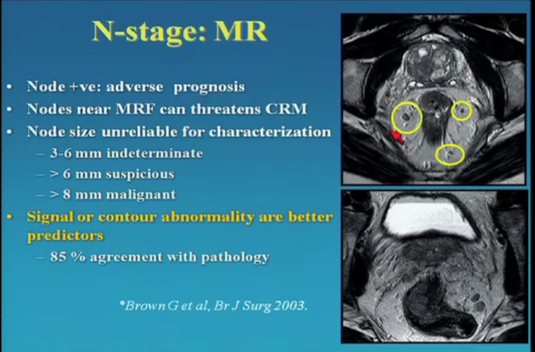 Rsna Staging Of Colon And Rectal Cancer