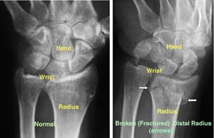 SMITH’s FRACTURE