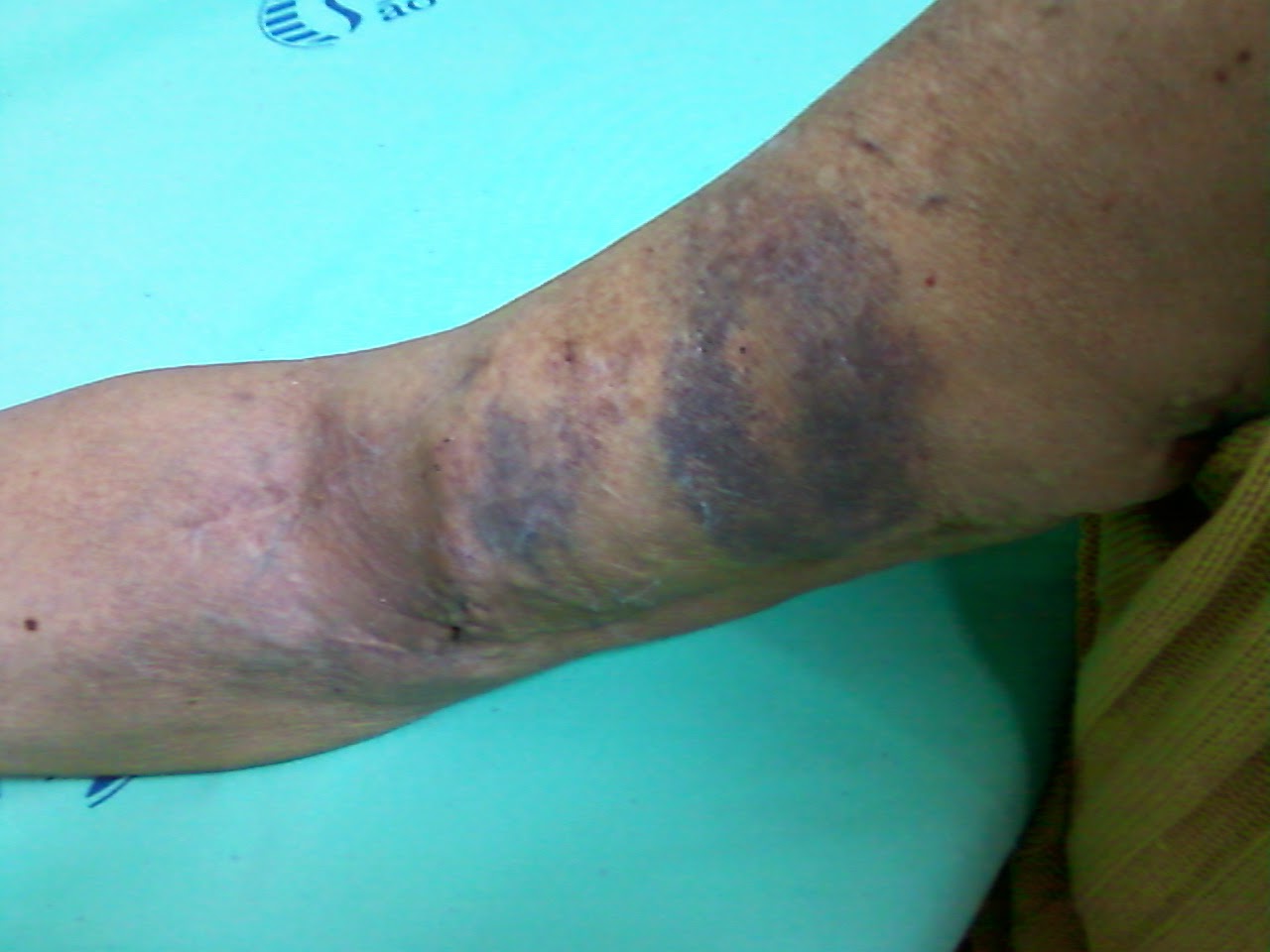 FISIOTERAPIA VOLTADA PARA FÍSTULA ARTERIOVENOSA: INFILTRAÇÃO DE FÍSTULA ...