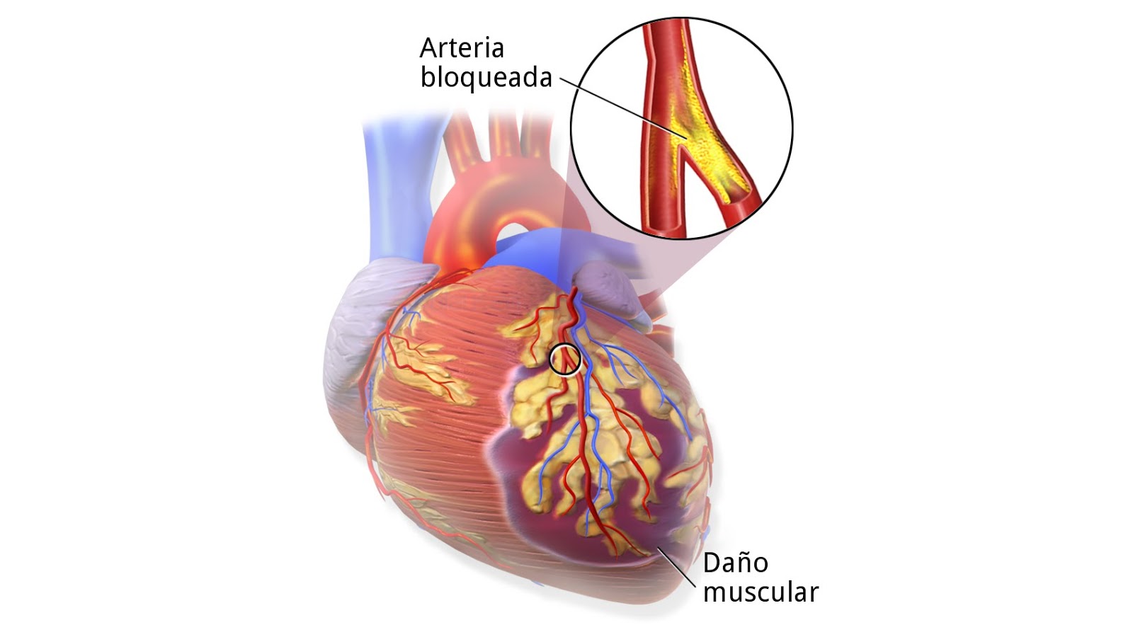 O Que é Isquemia Cardíaca - RETOEDU