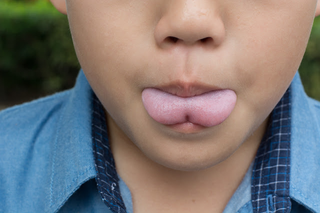 Tongue Tie (Ankyloglossia) - Parent's Guide