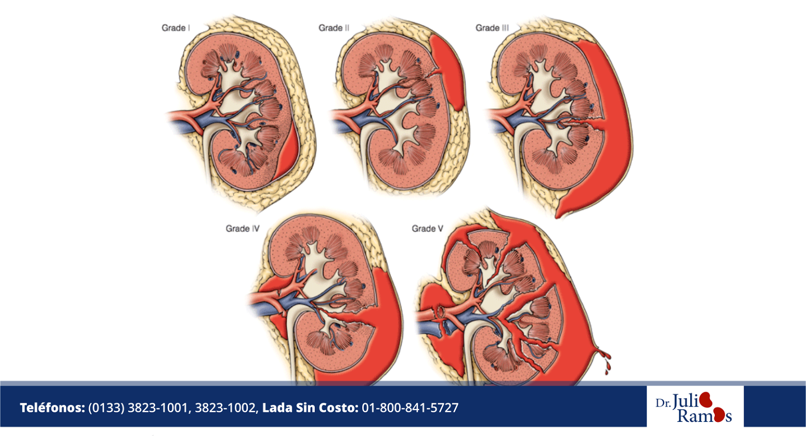 Dr. Julio Ramos - Nefrologo: Traumatismo Renal