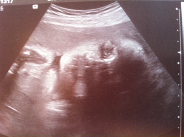 Baby Foley's Nine Month Chronicle: 32 Week Ultrasound