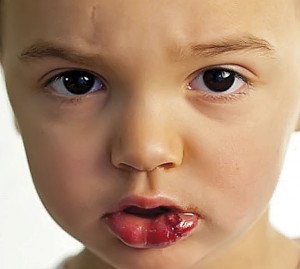 GOLPES EN LA CARA Y CONSECUENCIAS EN NIÑOS - 🦷Con Dientes - Salud Bucal