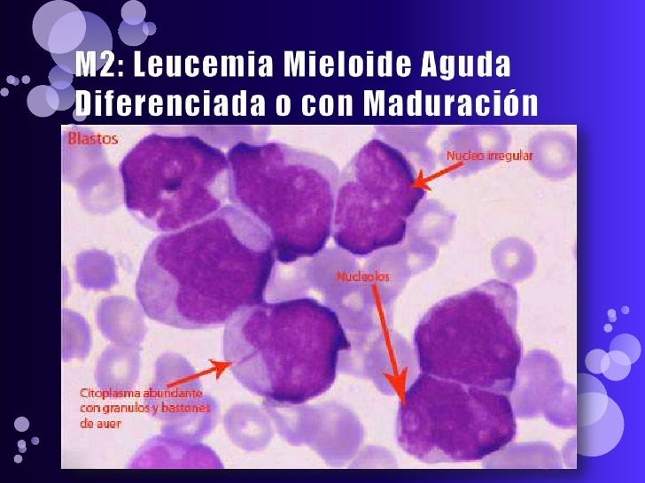 Células Sanguíneas: Leucemias Mieloides Agudas