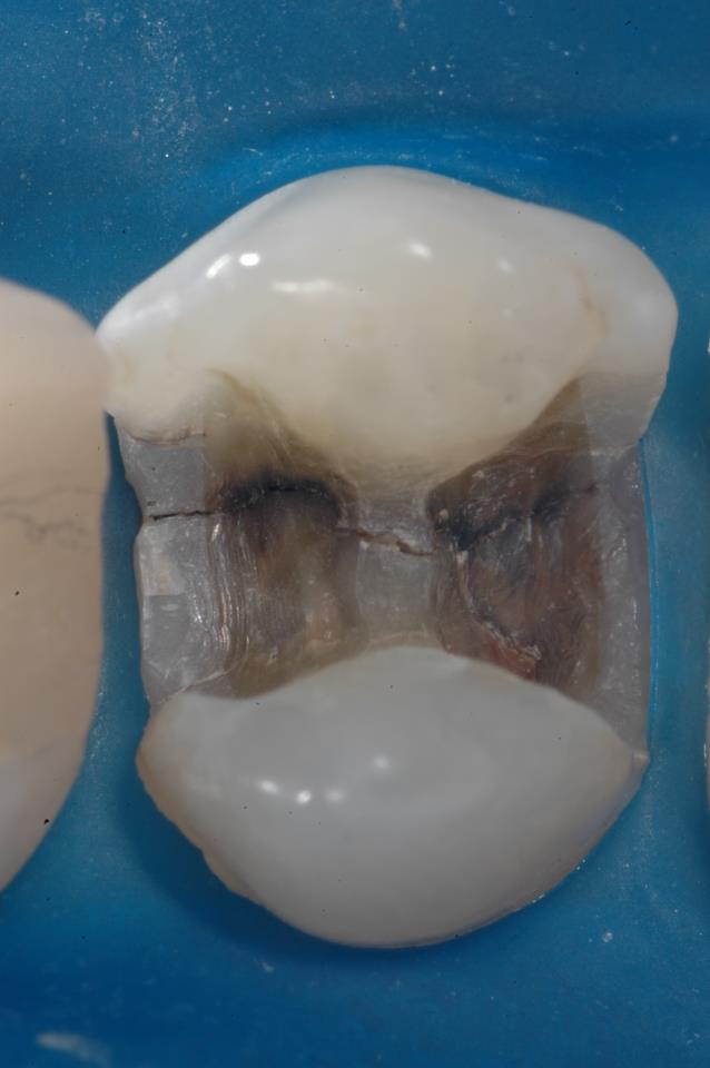 Odontología sin chorradas: Amalgamas de plata (empastes metálicos). O ...