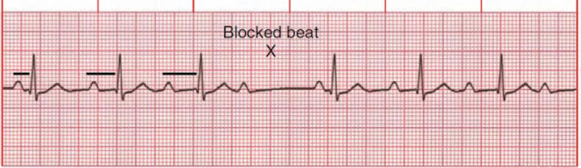 Second Degree Atrioventricular Block (Blok AV Derajat II) - JANTUNG OKE