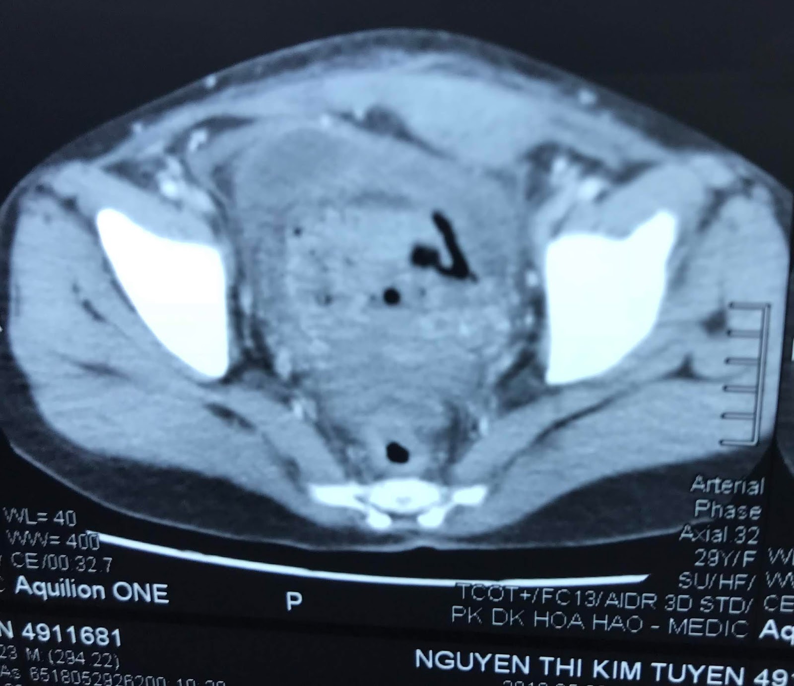 VIETNAMESE MEDIC ULTRASOUND: CASE 496: POST-PARTUM PELVIS ABSCESS, Dr ...