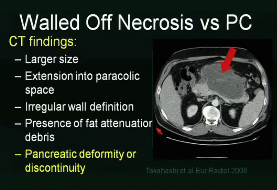 rsna: Acute pancreatitis