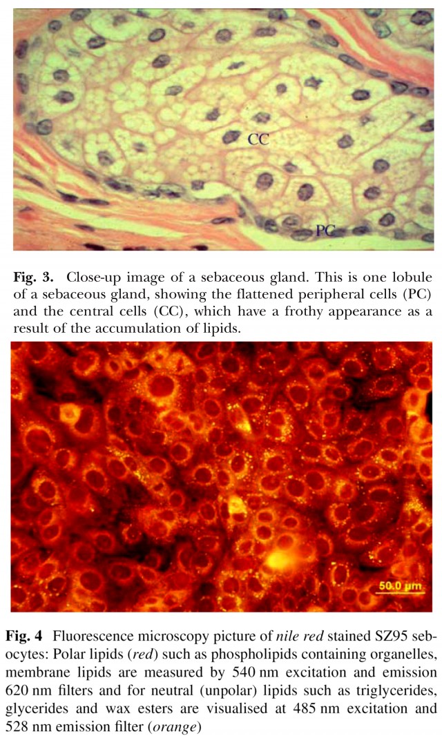 Get Rid of Acne Overnight and Forever: Sebaceous Gland Lipids and Acne