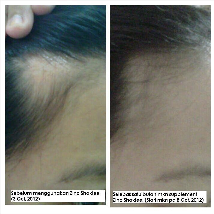 Sihat Cantik Tertawan ;Shaklee: Rimas Dengan Masalah Rambut Gugur?Punca ...