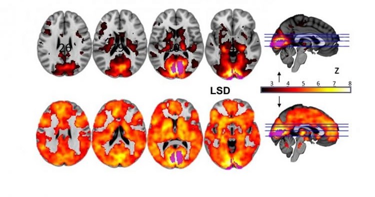 BRAIN-COMPUTER INTERFACES over EEG: LSD effect in Human Brain
