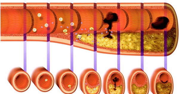 Health Knowledge : How to treat high blood lipids Treatment of high ...