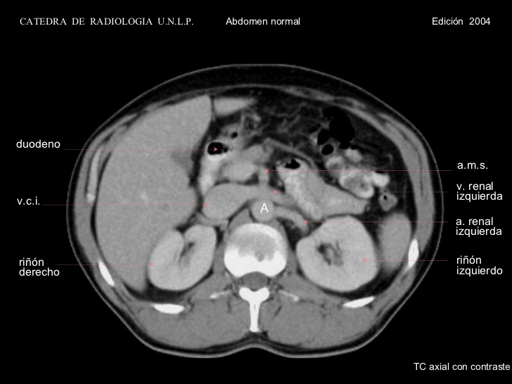 Anatomía Radiológica del Aparato Genitourinario, Urinario. UROGRAFÍA Y TC.