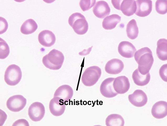 AMIGOS PARA SIEMPRE: MORFOLOGÍA ANORMAL DE LOS ERITROCITOS